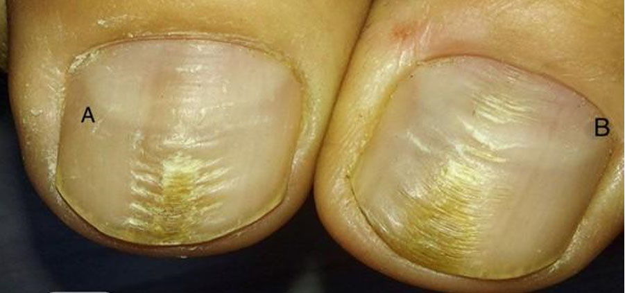 Coexisting median canaliform nail dystrophy and habit-tic deformity ...